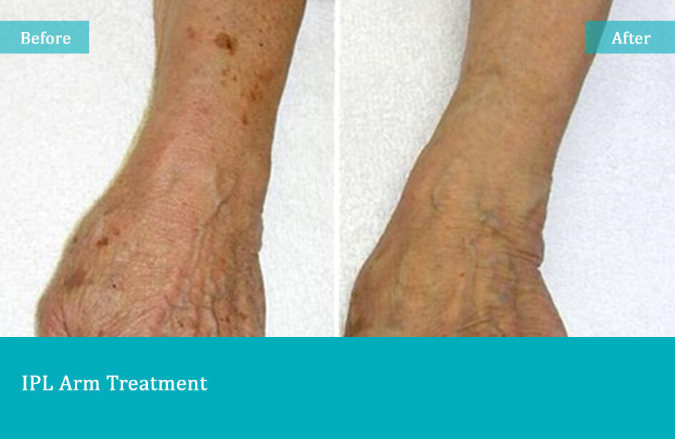 LimeLight IPL Skin Rejuvenation - San Diego / La Mesa CA - Trilogy Health