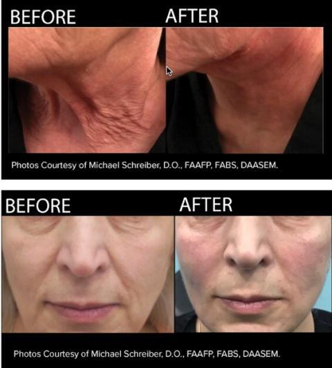 PDO threading non-surgical skin lift San Diego - San Diego / La Mesa CA ...